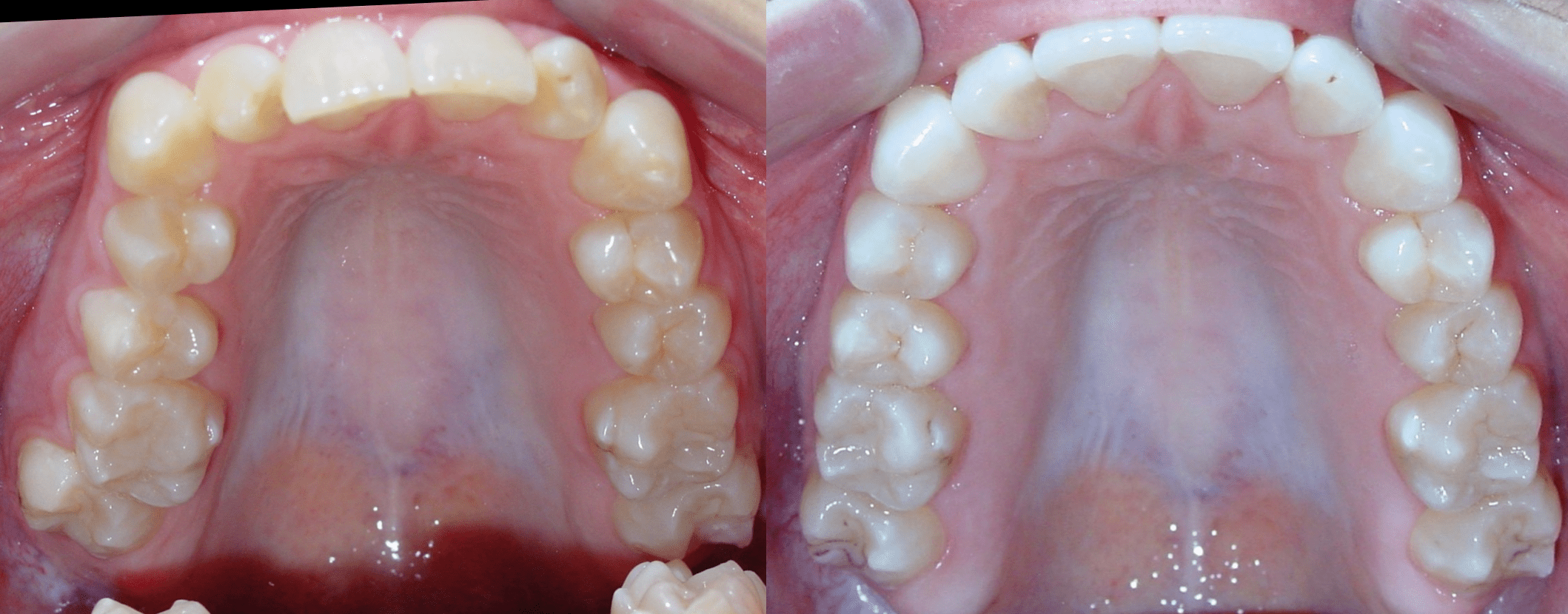 Case Study 17 - Narrow Smiles - Bandeen Orthodontics