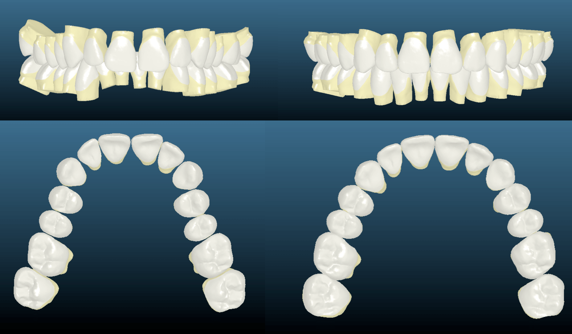 Case Study 16 - Narrow Smiles - Bandeen Orthodontics