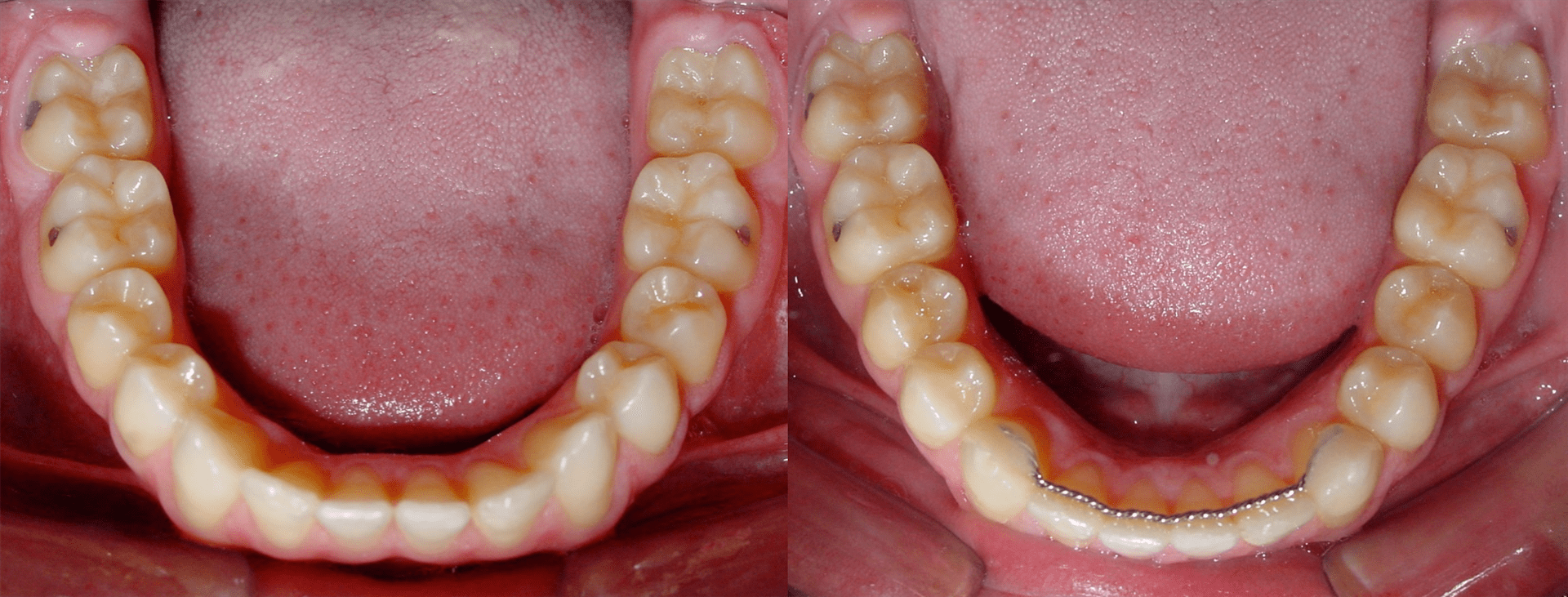Case Study 4 - Orthodontic Class II - Bandeen Orthodontics
