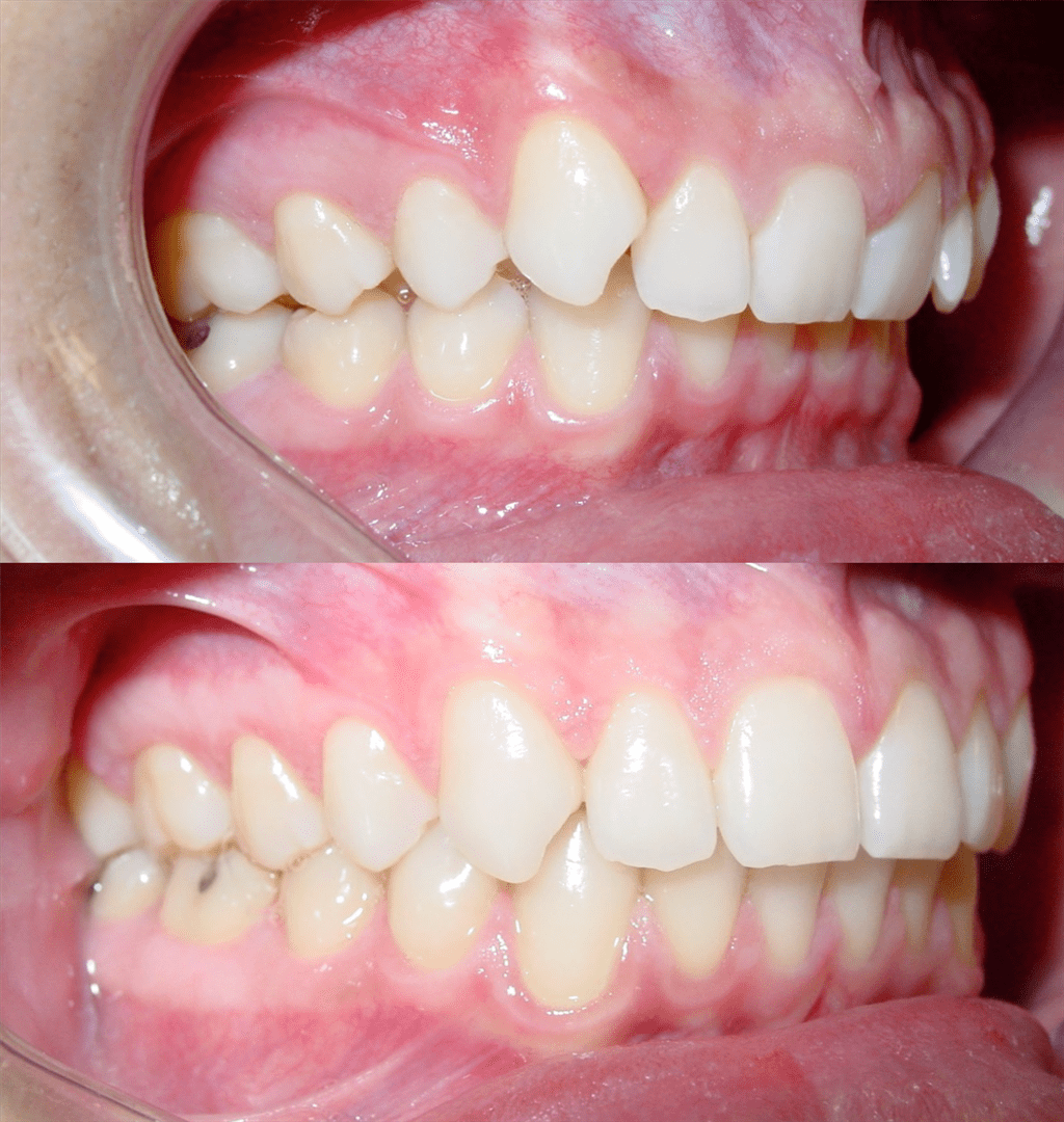 Case Study 4 - Orthodontic Class II - Bandeen Orthodontics