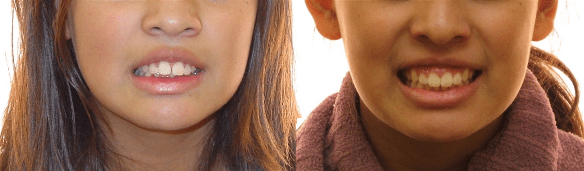 Case Study 2 - Orthodontic Class II - Bandeen Orthodontics
