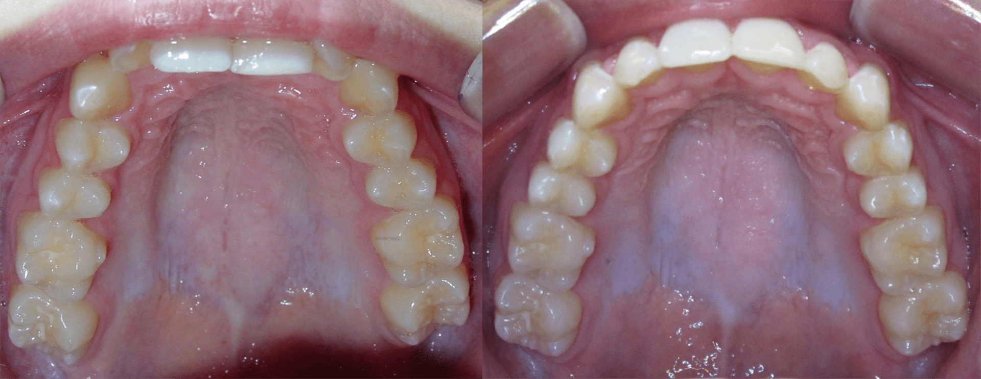Case Study 5 - Orthodontic Class II - Bandeen Orthodontics