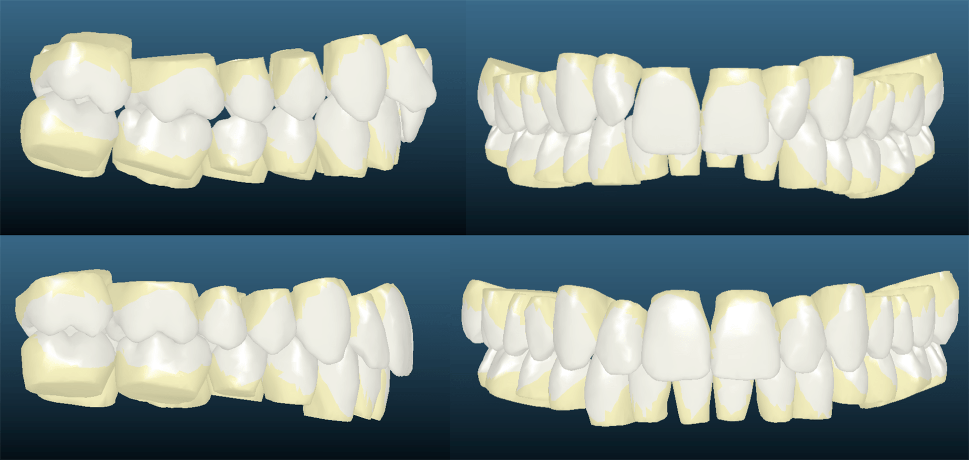 Case Study 5 - Orthodontic Class II - Bandeen Orthodontics