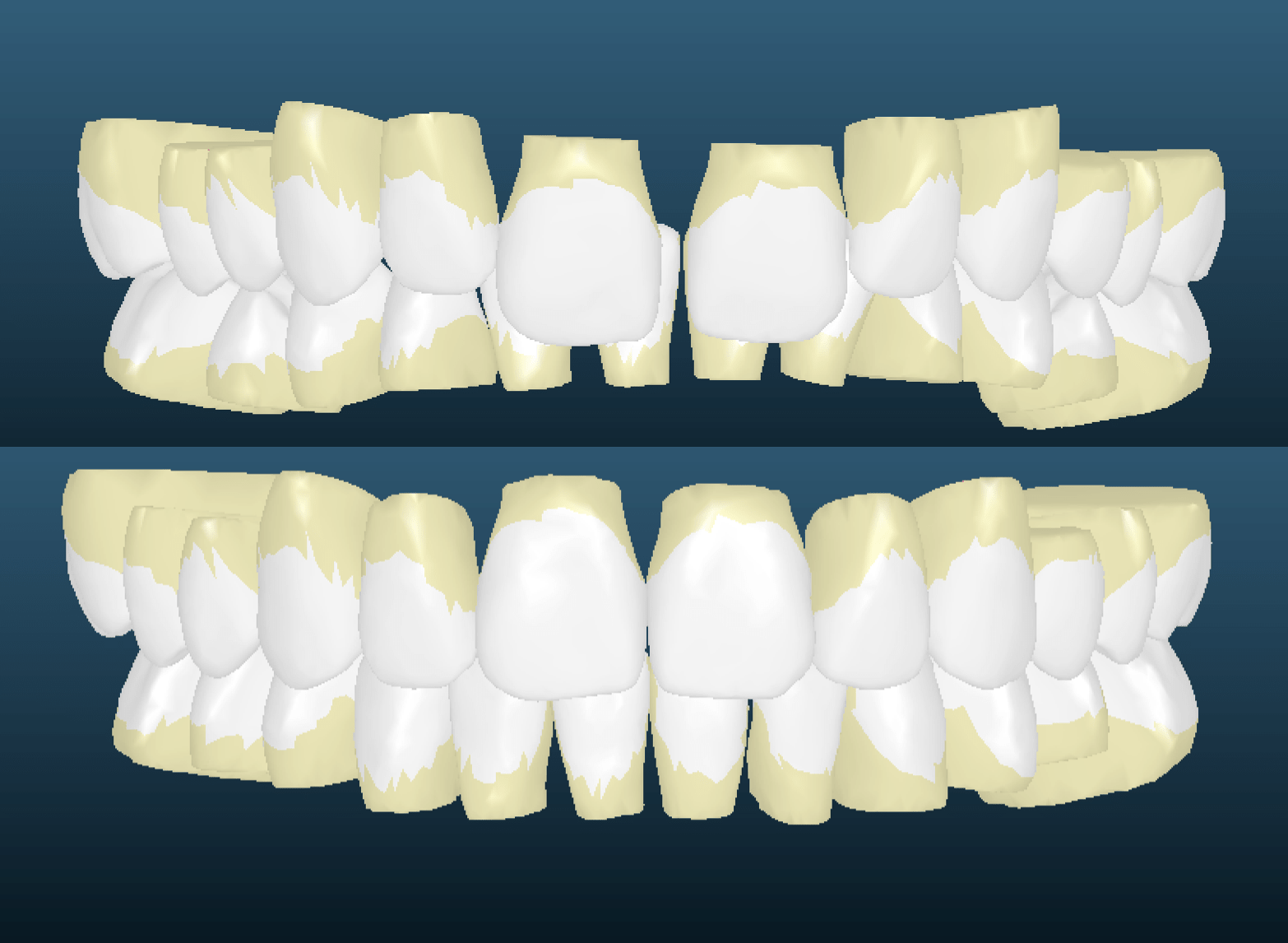 Case Study 71 - Spaces between teeth - Bandeen Orthodontics