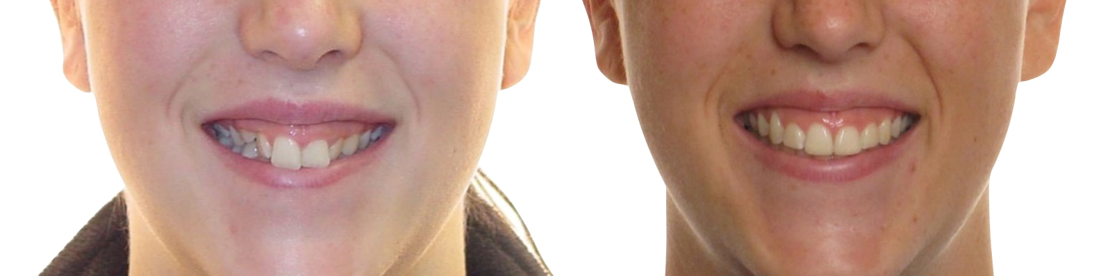 Case Study 32 - Narrow Smiles - Bandeen Orthodontics