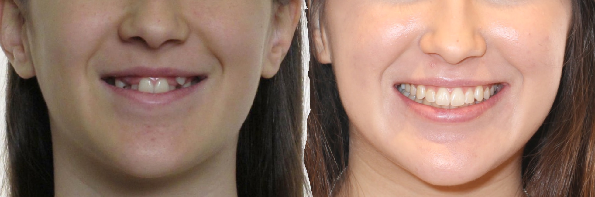 Case Study 22 - Narrow Smiles - Bandeen Orthodontics