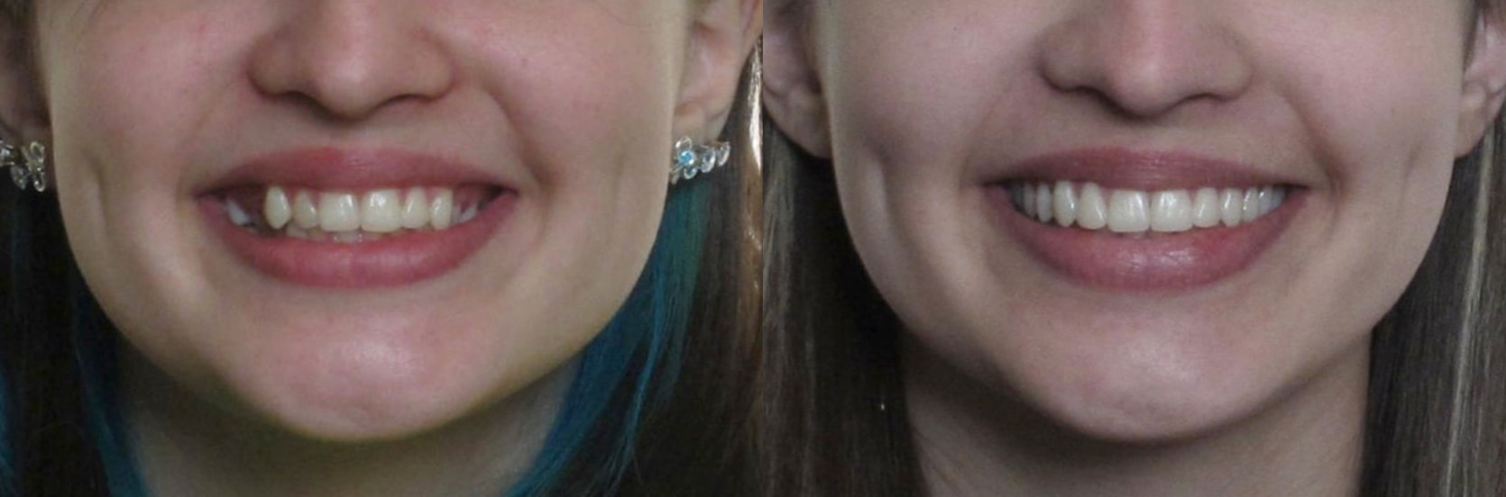 Case Study 24 - Narrow Smiles - Bandeen Orthodontics