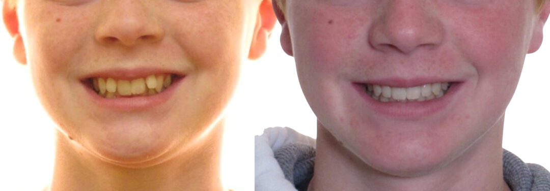 Case Study 25 - Narrow Smiles - Bandeen Orthodontics