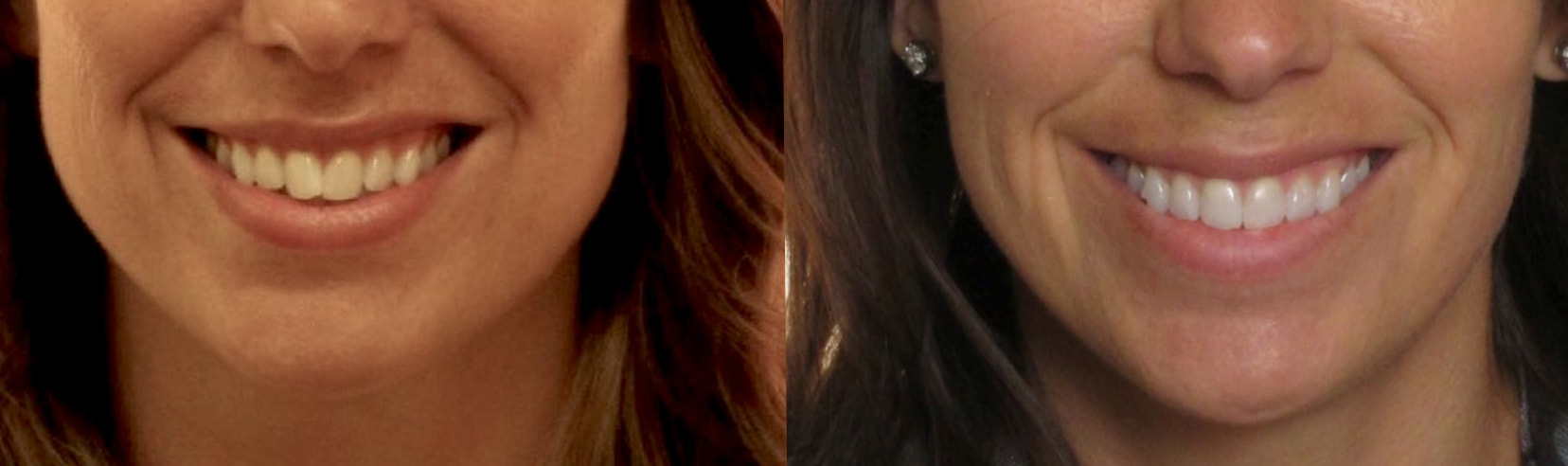 Case Study 27 – Narrow Smiles - Bandeen Orthodontics