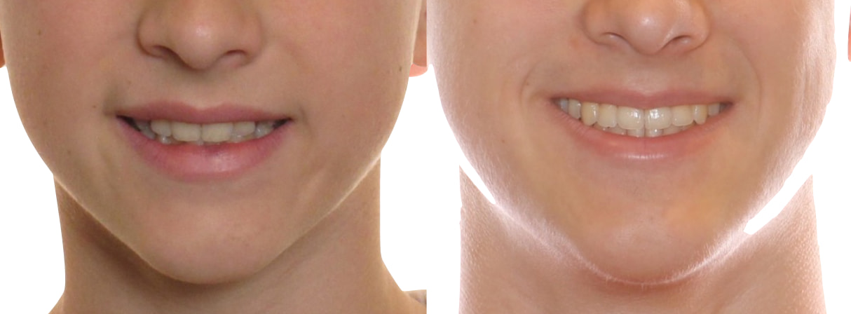 Case Study 28 - Narrow Smiles - Bandeen Orthodontics