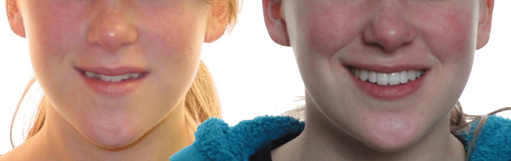 Case Study 19 - Narrow Smiles - Bandeen Orthodontics