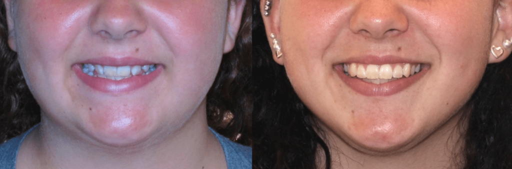 Case Study 20 - Narrow Smiles - Bandeen Orthodontics