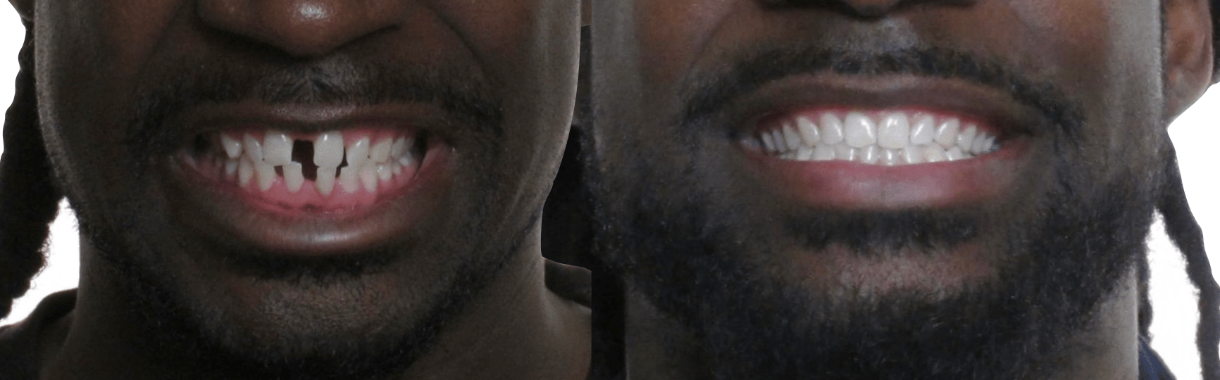 Case Study 68 - Spaces between teeth (Invisalign) - Bandeen Orthodontics