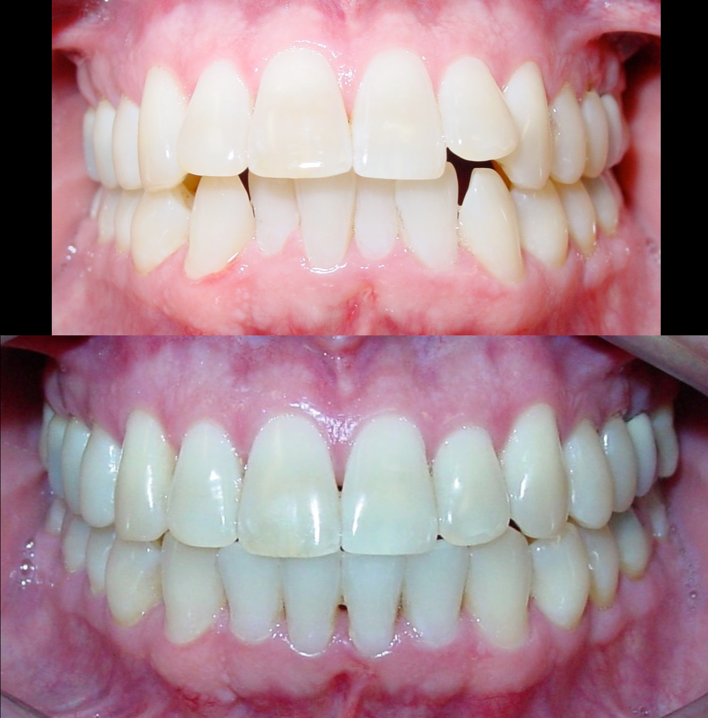 Case Study 30 - Narrow Smiles - Bandeen Orthodontics