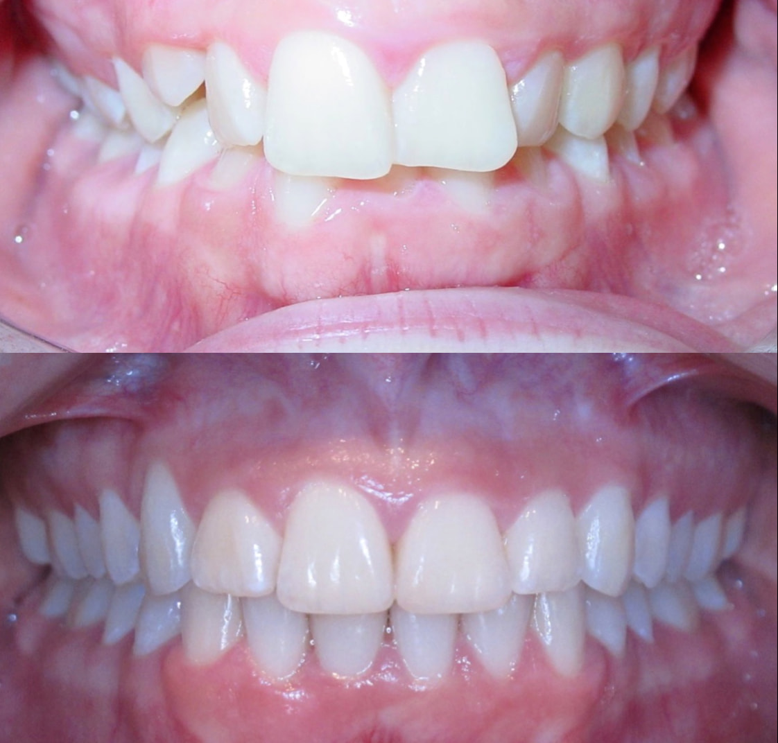 Case Study 32 - Narrow Smiles - Bandeen Orthodontics