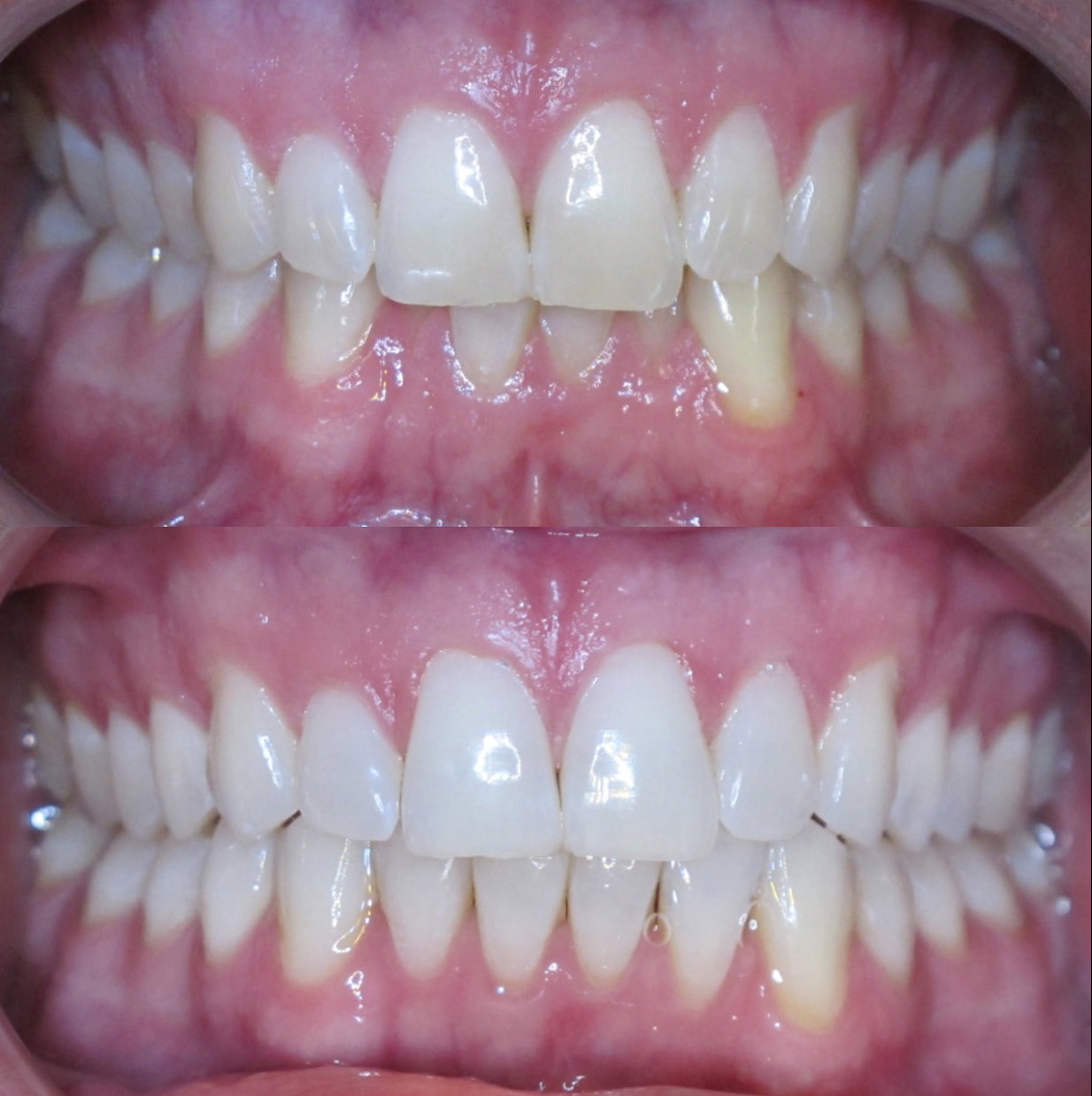 Case Study 23 - Narrow Smiles - Bandeen Orthodontics