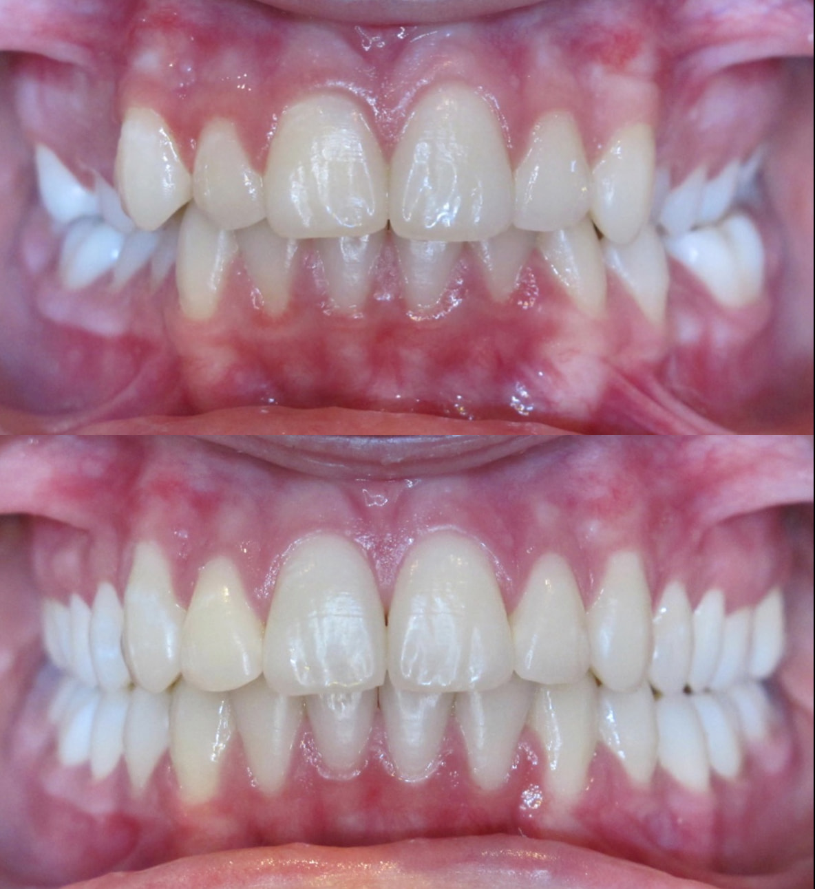 Case Study 24 - Narrow Smiles - Bandeen Orthodontics