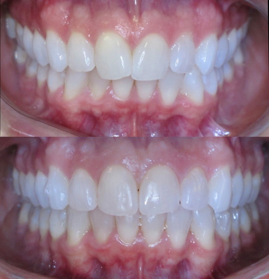 Case Study 27 – Narrow Smiles - Bandeen Orthodontics