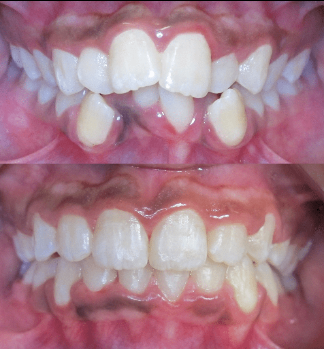 Case Study 13 Extractions Bandeen Orthodontics