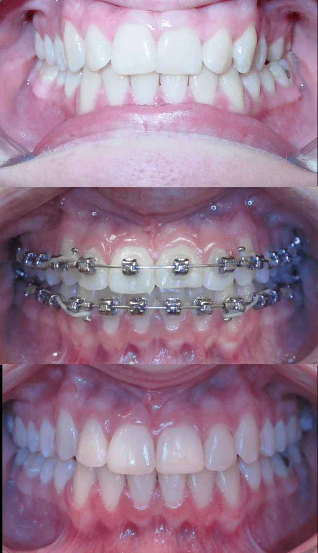 Case Study 57 - Short Tooth - Bandeen Orthodontics