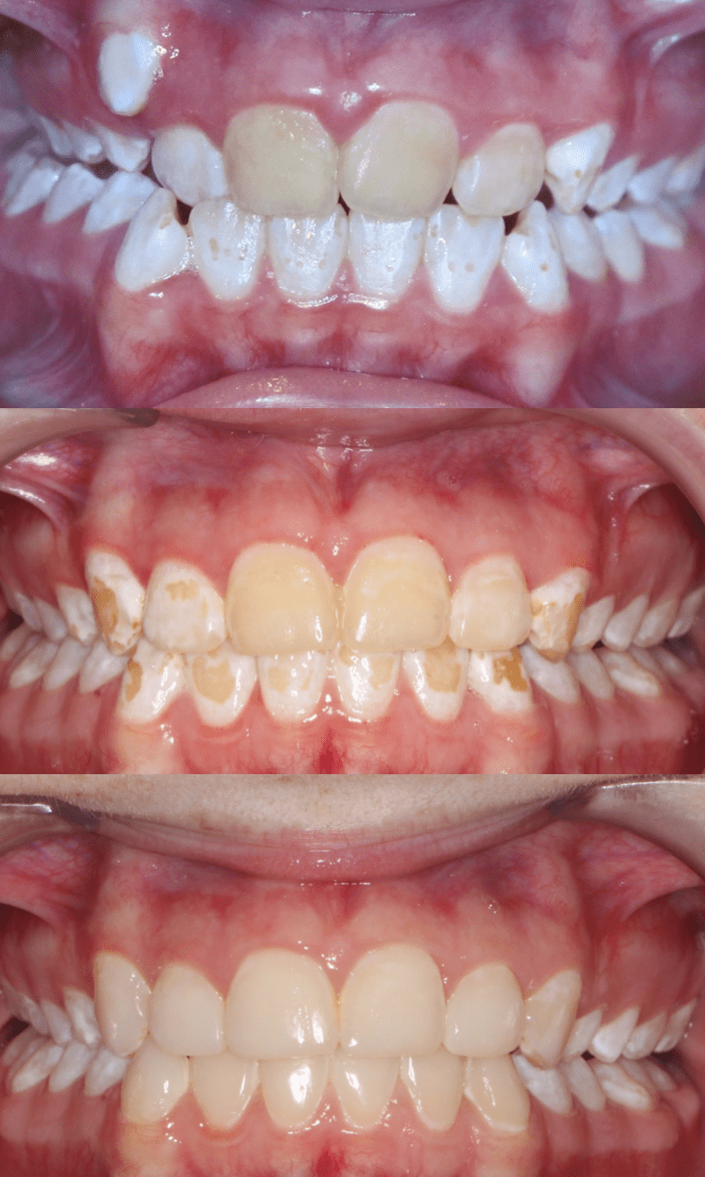 Case Study 59 - Brown Stains on Teeth - Bandeen Orthodontics