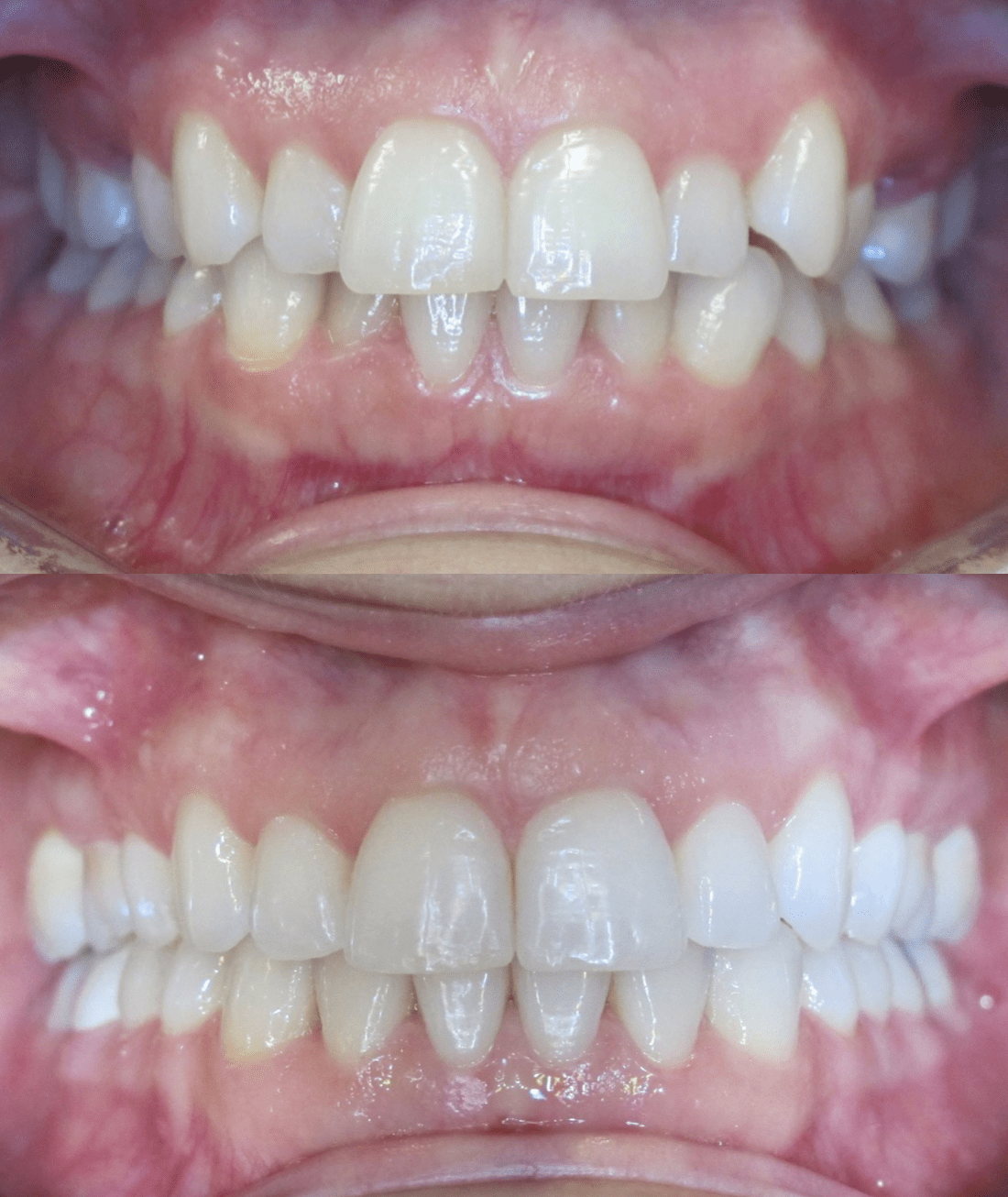 Case Study 79 - Missing upper second premolars, and camouflaged the ...