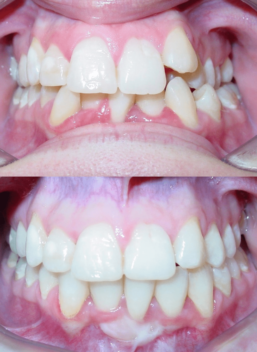 Case Study 83 - Missing a lower incisor, upper right first premolar ...