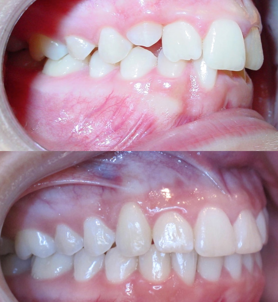 Case Study 32 - Narrow Smiles - Bandeen Orthodontics