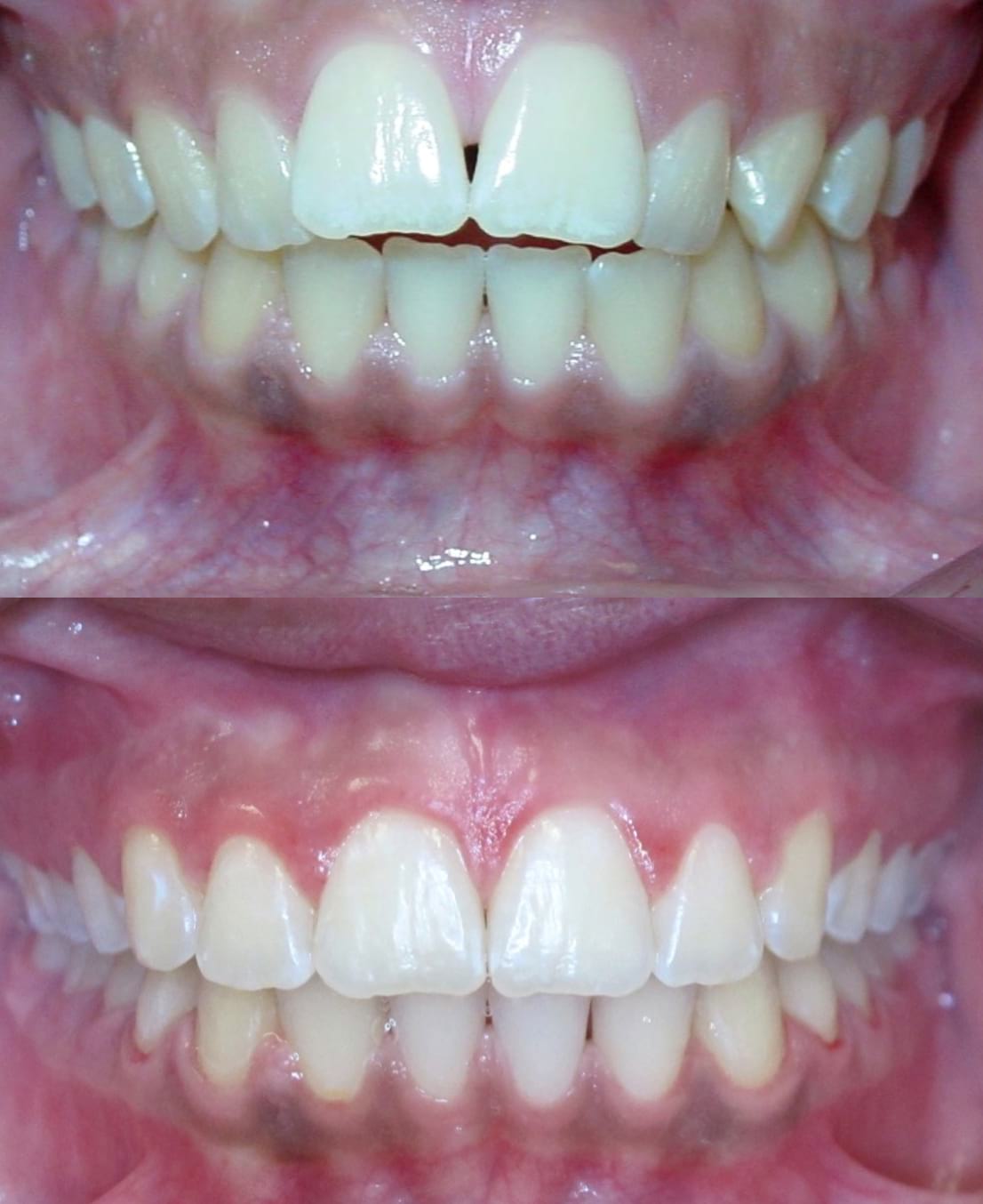 Full Orthodontic Treatment | Bandeen Orthodontics | Michigan