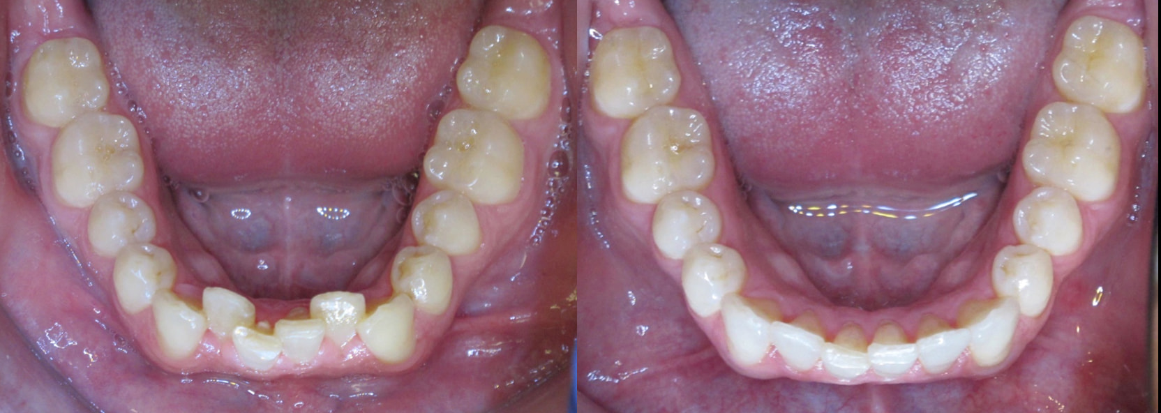 Case Study 23 - Narrow Smiles - Bandeen Orthodontics