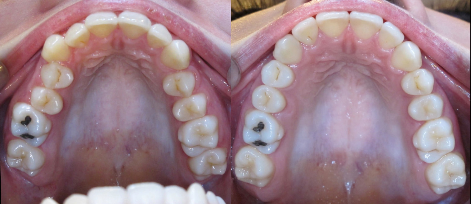 Case Study 24 - Narrow Smiles - Bandeen Orthodontics