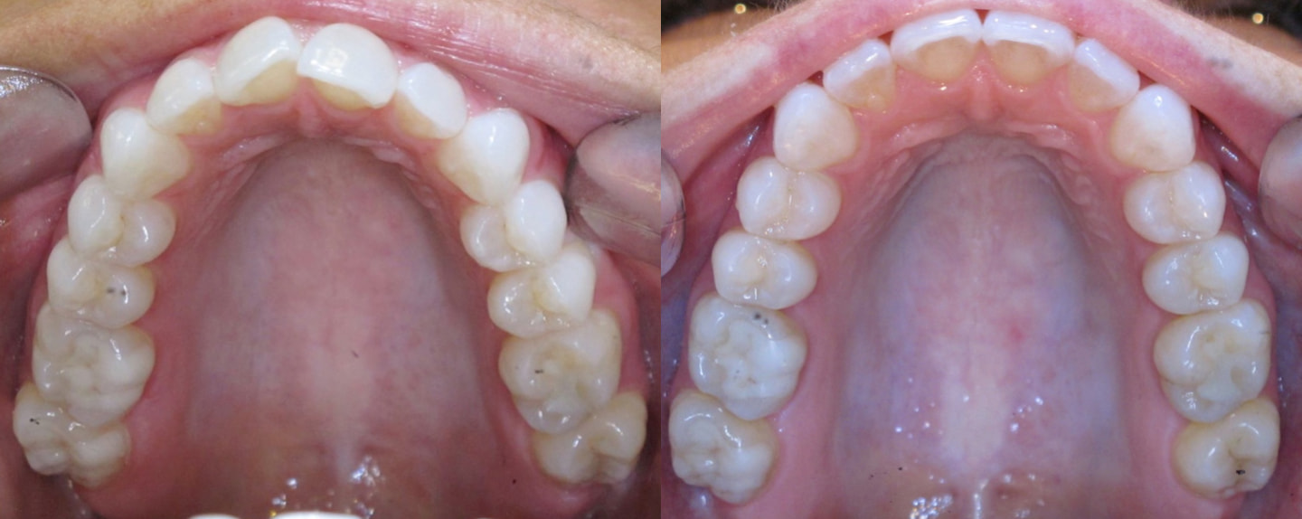 Case Study 27 – Narrow Smiles - Bandeen Orthodontics