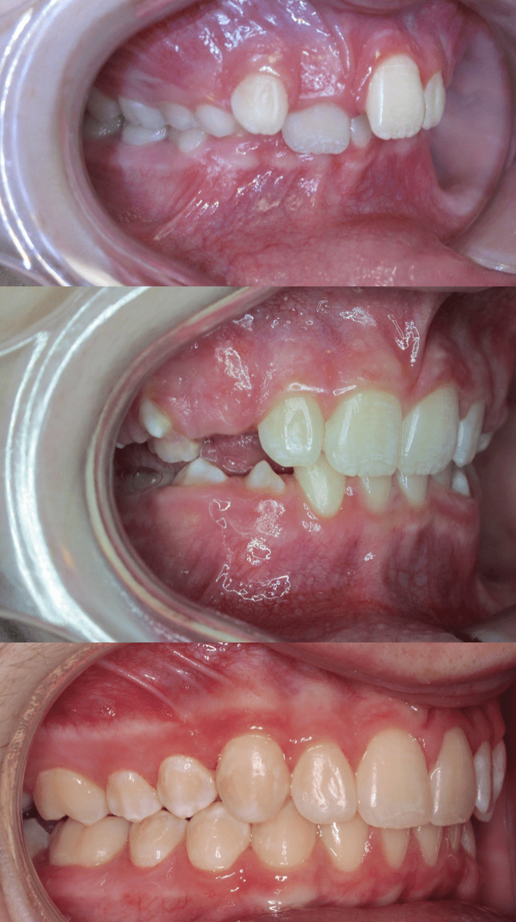 Case Study 46 - Frankel - Bandeen Orthodontics