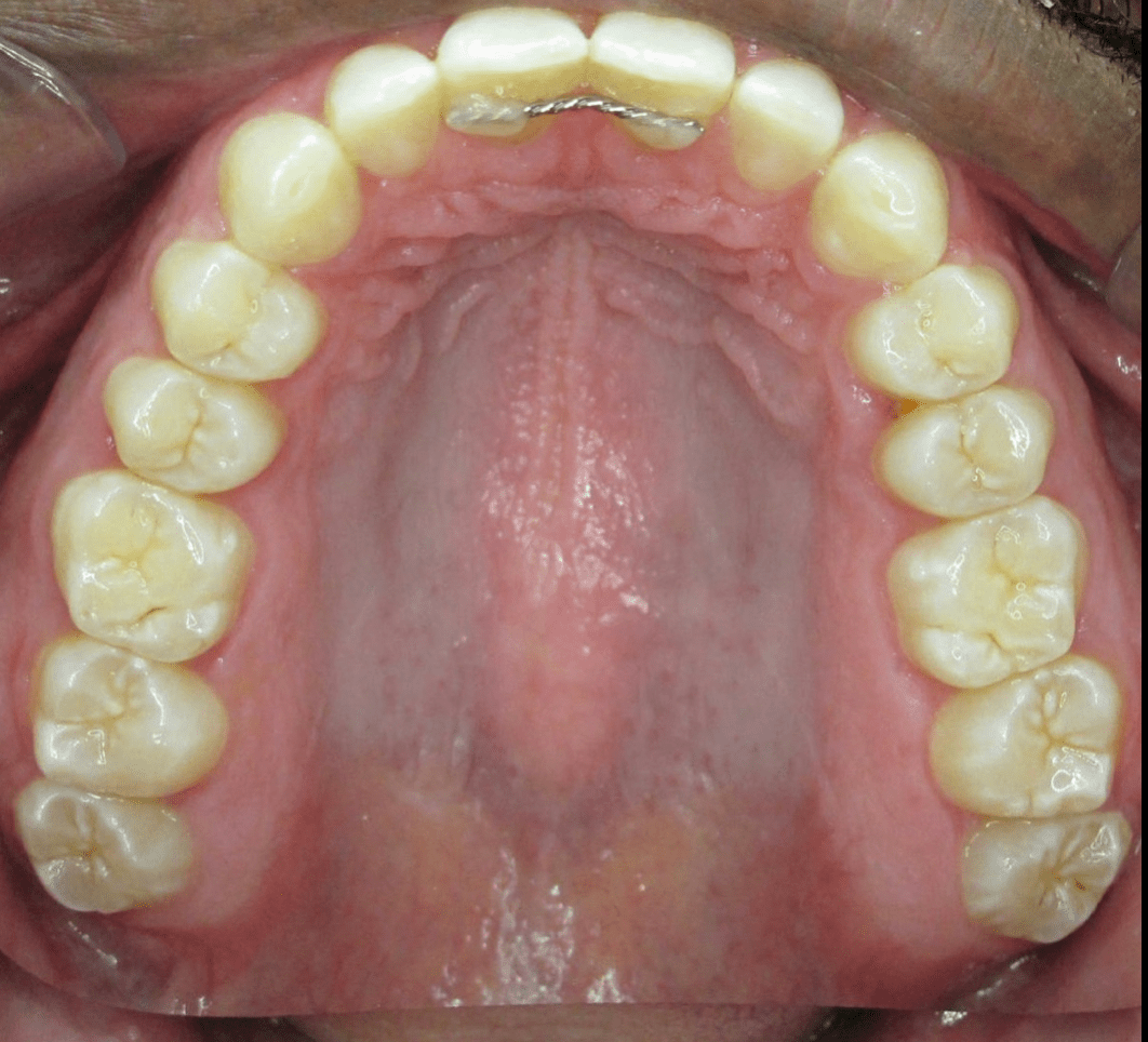 Case Study 68 - Spaces between teeth (Invisalign) - Bandeen Orthodontics