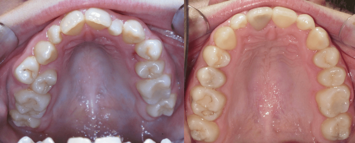 Case Study 50 - Premolar in the roof of the mouth - Bandeen Orthodontics