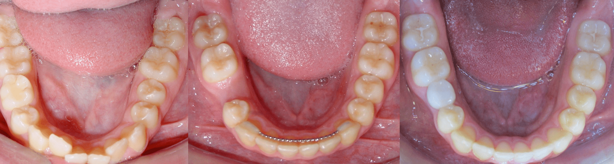 Case Study 76 - Missing lower right second premolar and replaced with ...