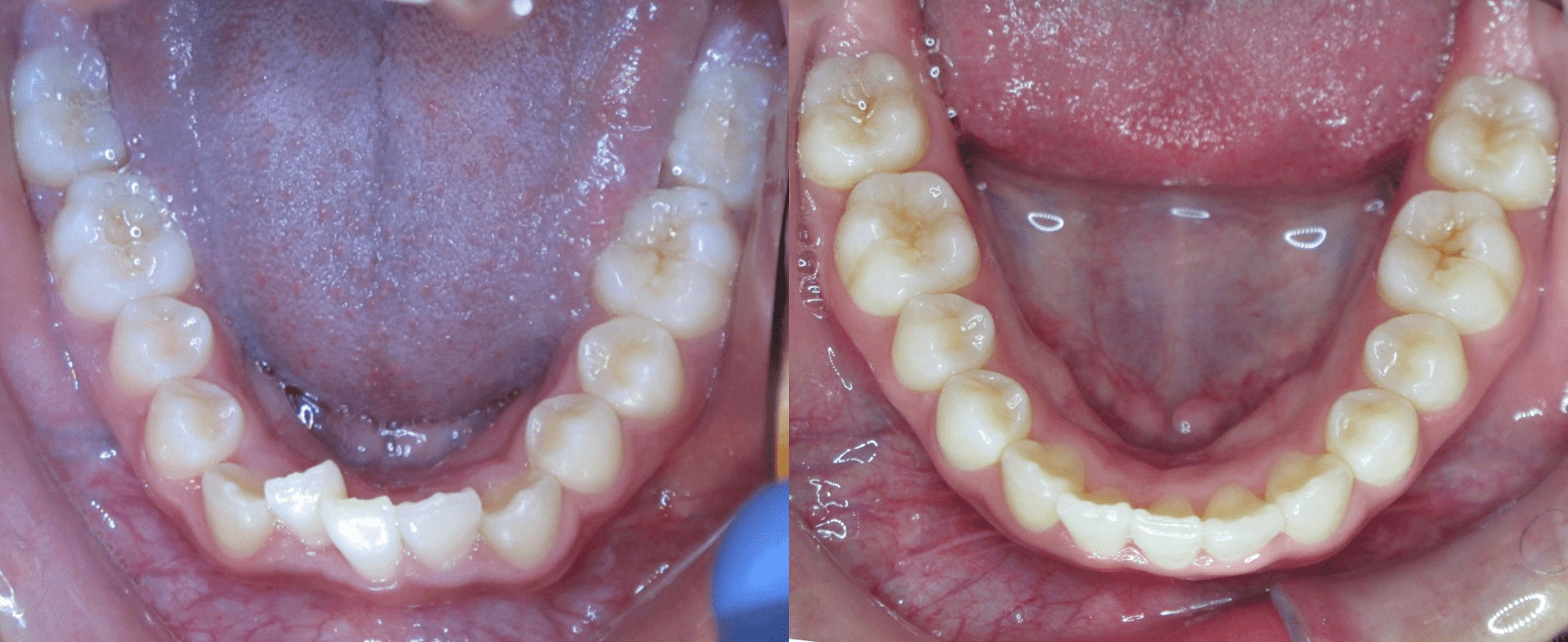 Case Study 82 - Missing a lower incisor, and camouflaged the absence of ...