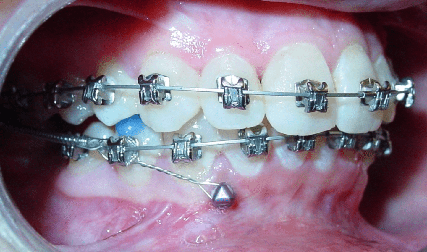 Case Study 84 - Missing a lower right first molar, and camouflaged the ...