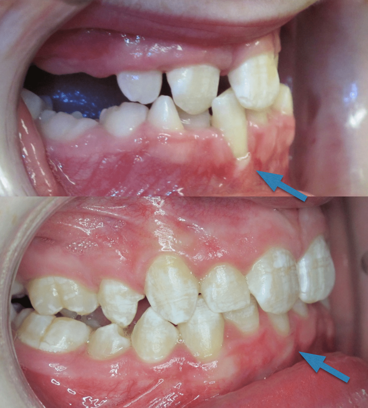 Case Study 43 - Crossbite - Bandeen Orthodontics
