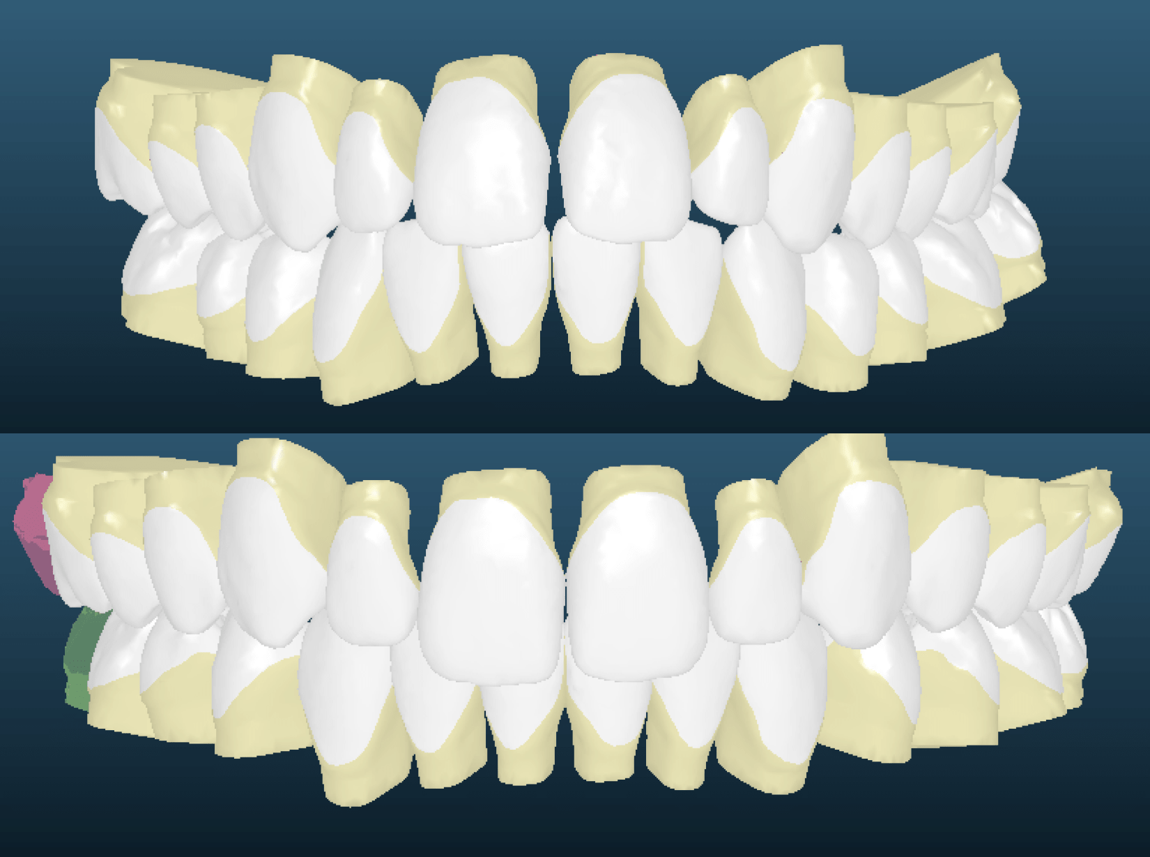 Case Study 60 - Length of teeth and " gummy" smile - Bandeen Orthodontics