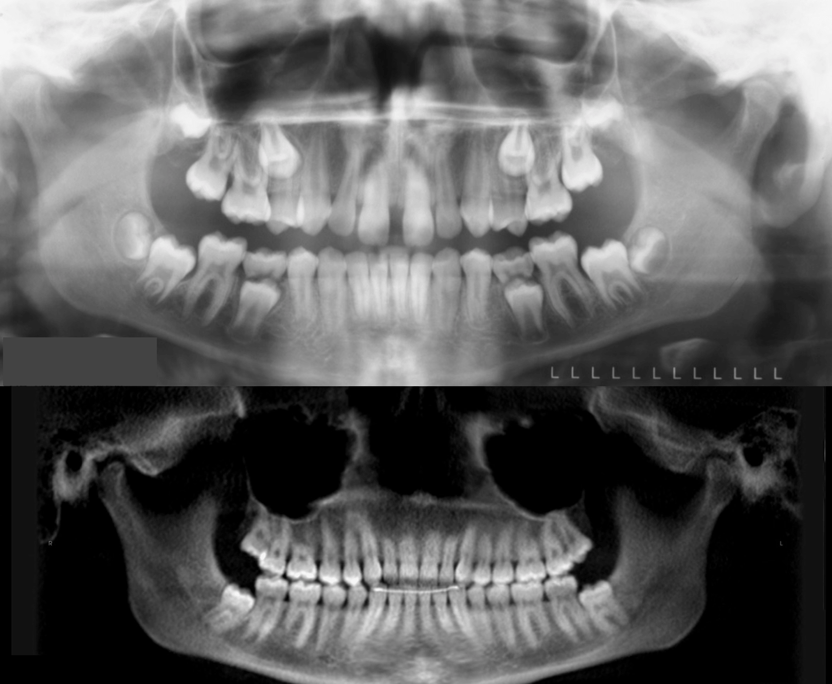 Case Study 73 - Second premolars impacted due to early loss of baby ...