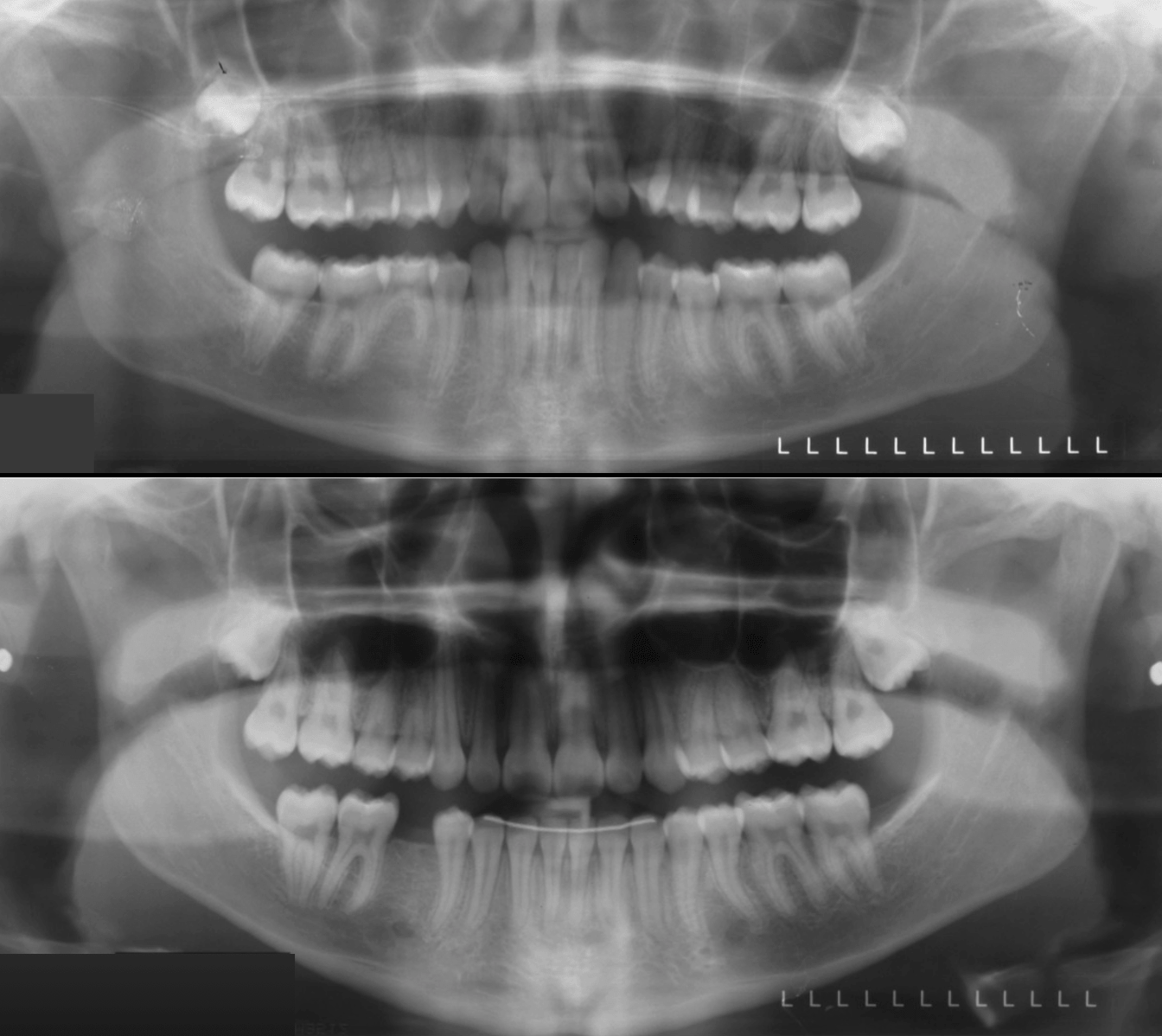 Case Study 76 - Missing lower right second premolar and replaced with ...