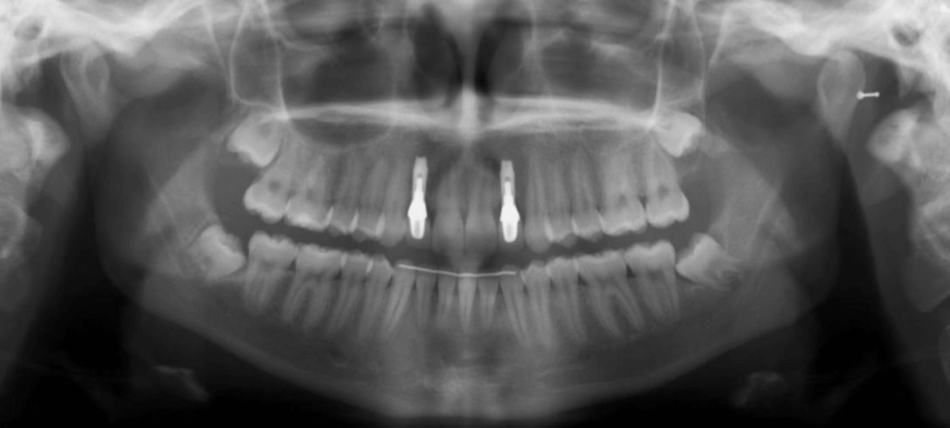 Case Study 77 - Missing upper right lateral incisor, peg upper left ...