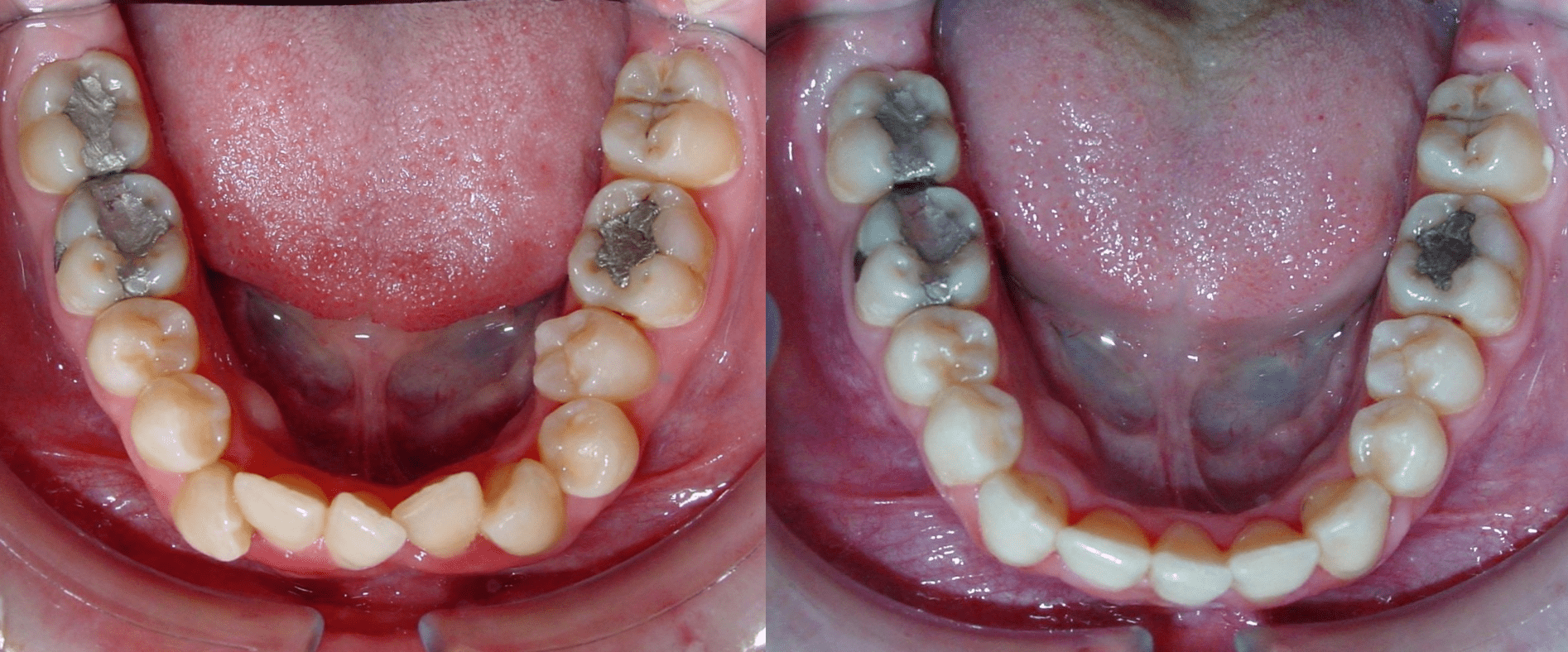 Case Study 83 - Missing a lower incisor, upper right first premolar ...