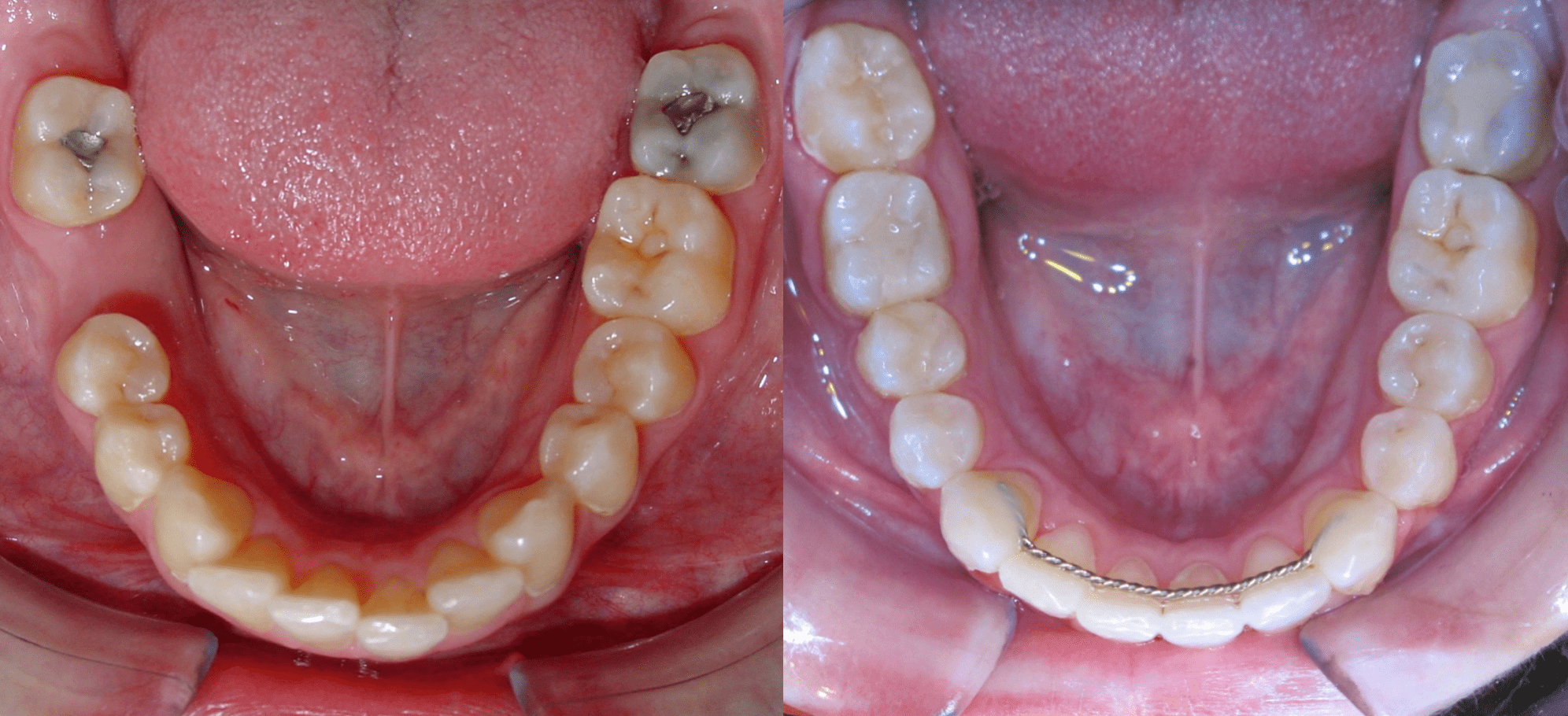 Case Study 84 - Missing a lower right first molar, and camouflaged the ...