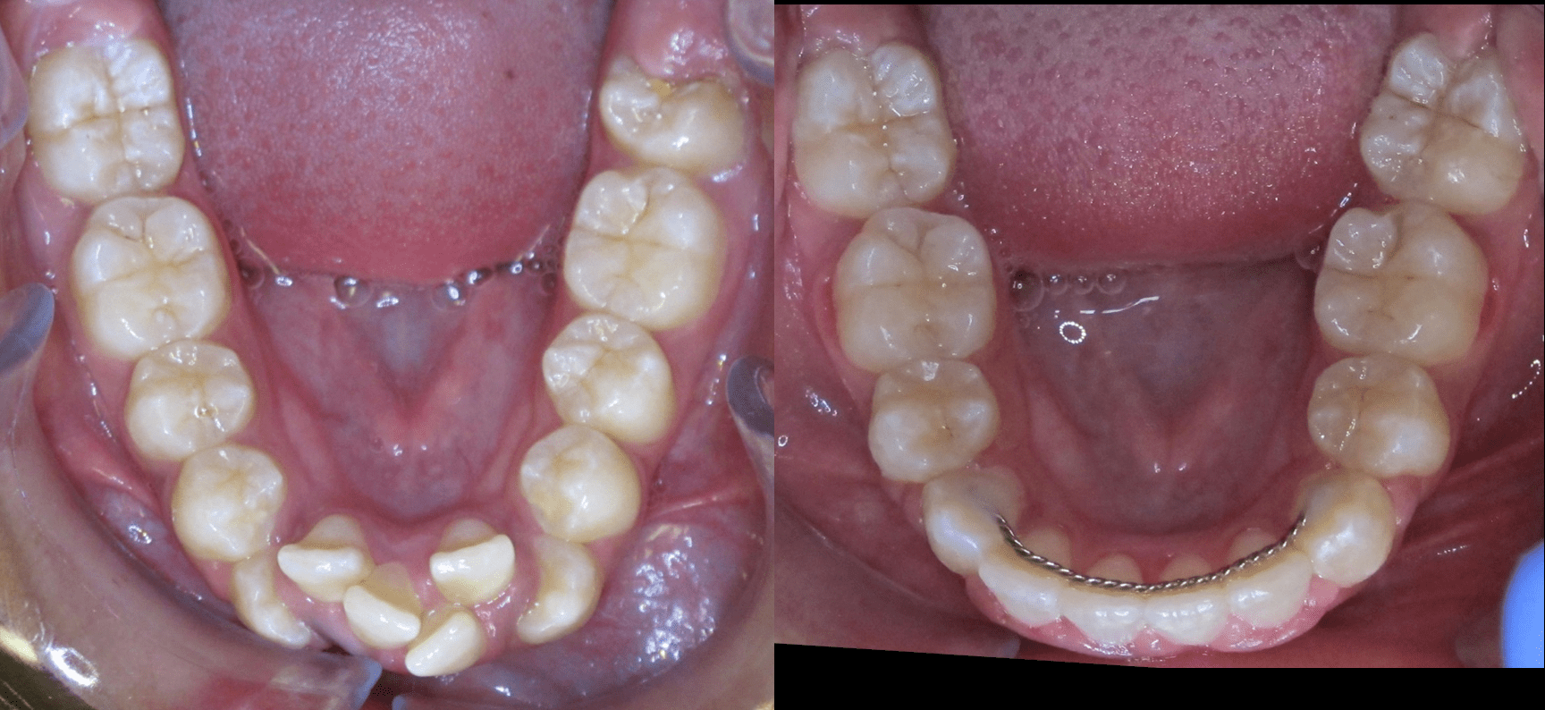 Case Study 13 Extractions Bandeen Orthodontics