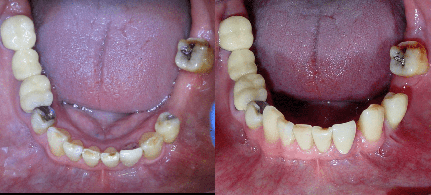 Case Study 80 - Deep bite with multiple molars and premolars missing ...