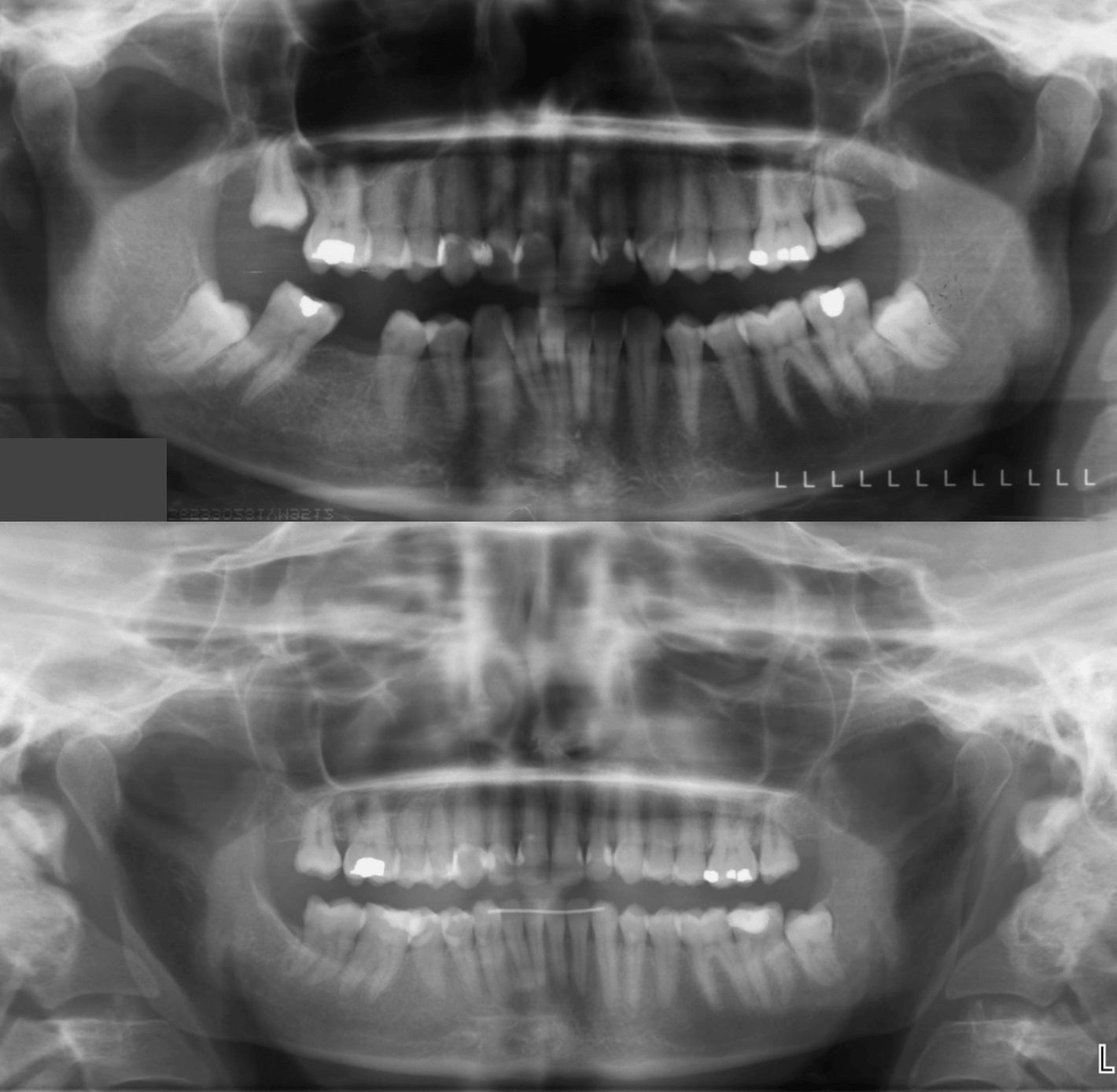 Case Study 84 - Missing a lower right first molar, and camouflaged the ...