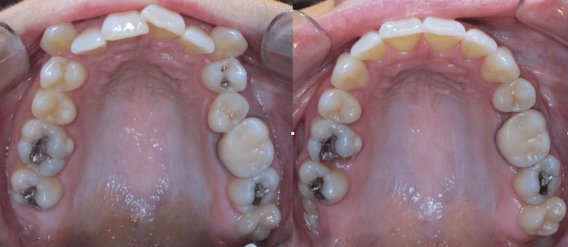 Case Study 14 Extractions Bandeen Orthodontics