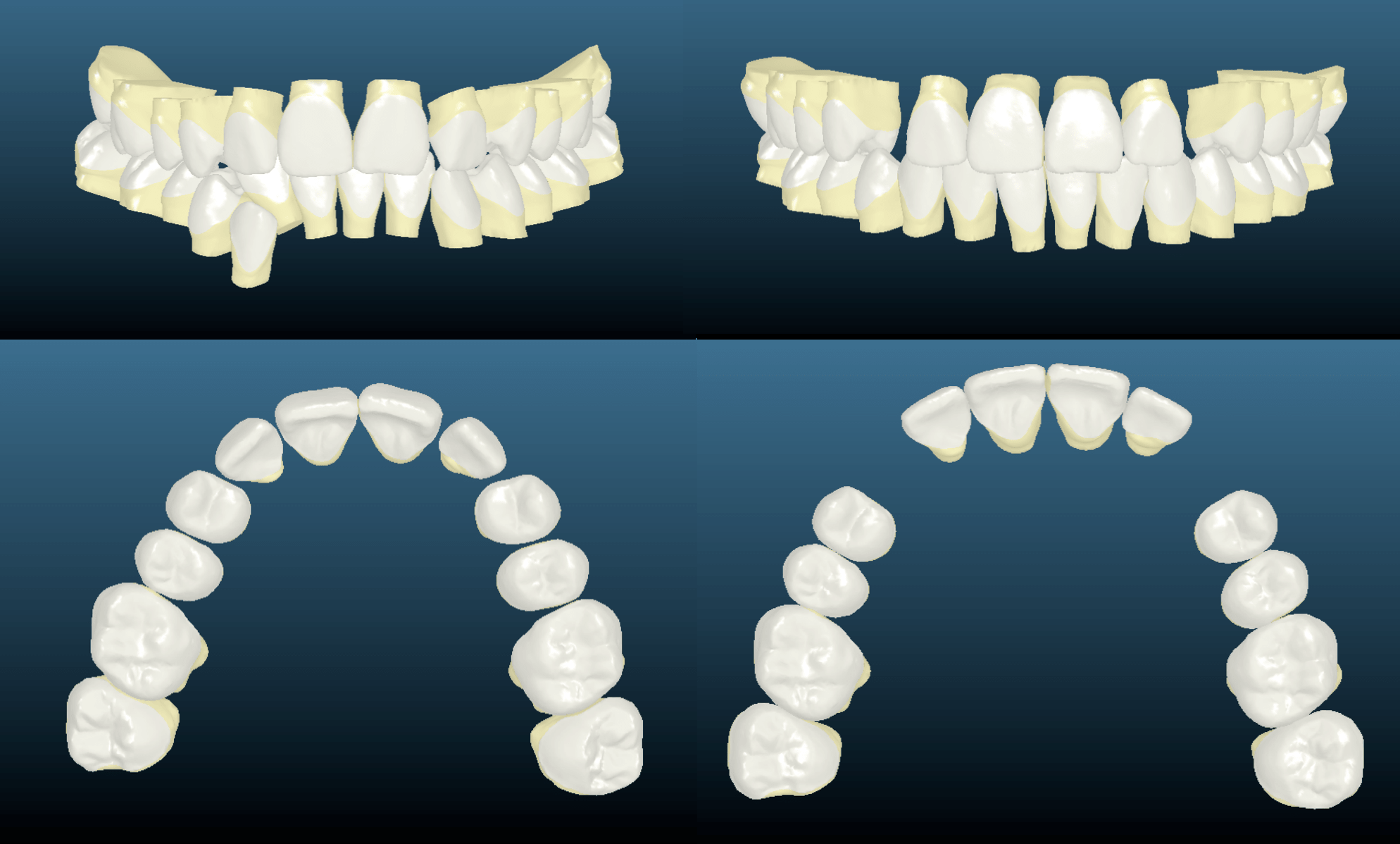 Case Study 20 - Narrow Smiles - Bandeen Orthodontics